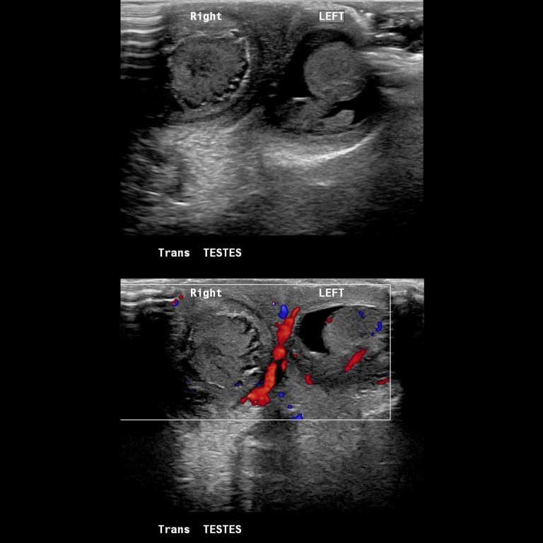 Pediatric Testicle Torsion | Pediatric Radiology Reference Article ...