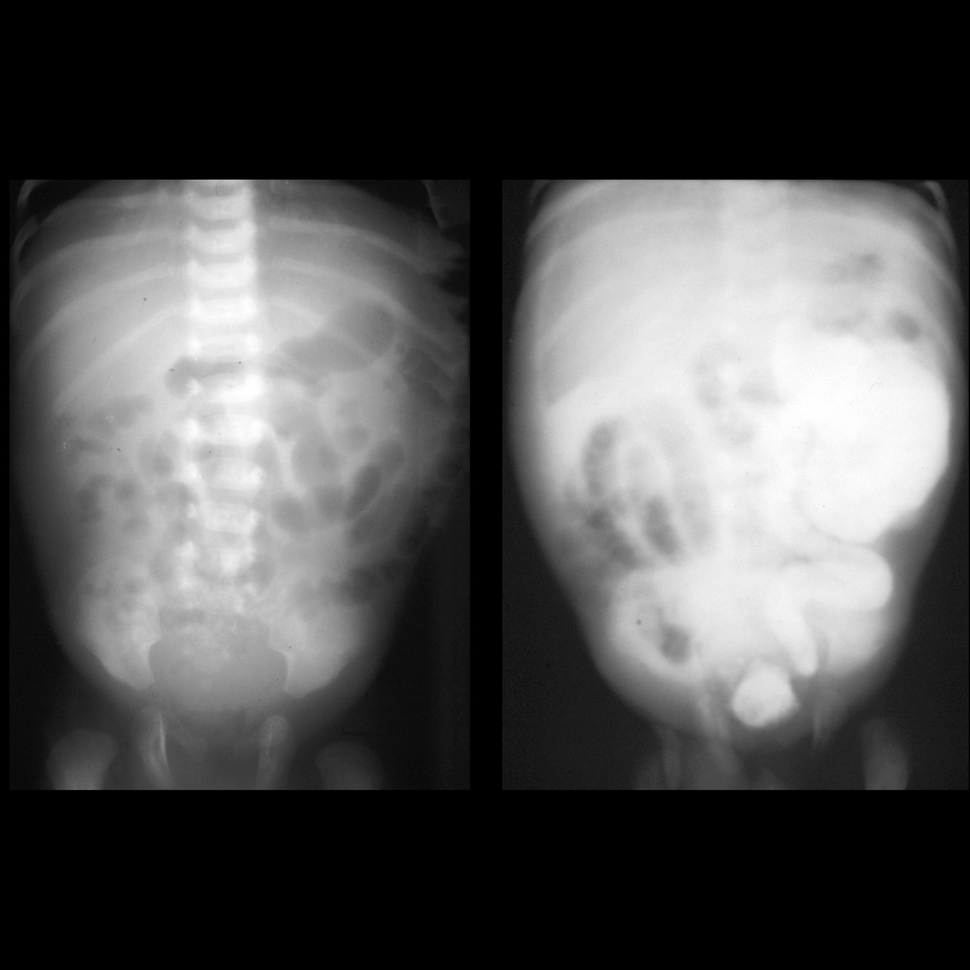 Pediatric Ascites | Pediatric Radiology Reference Article | Pediatric ...