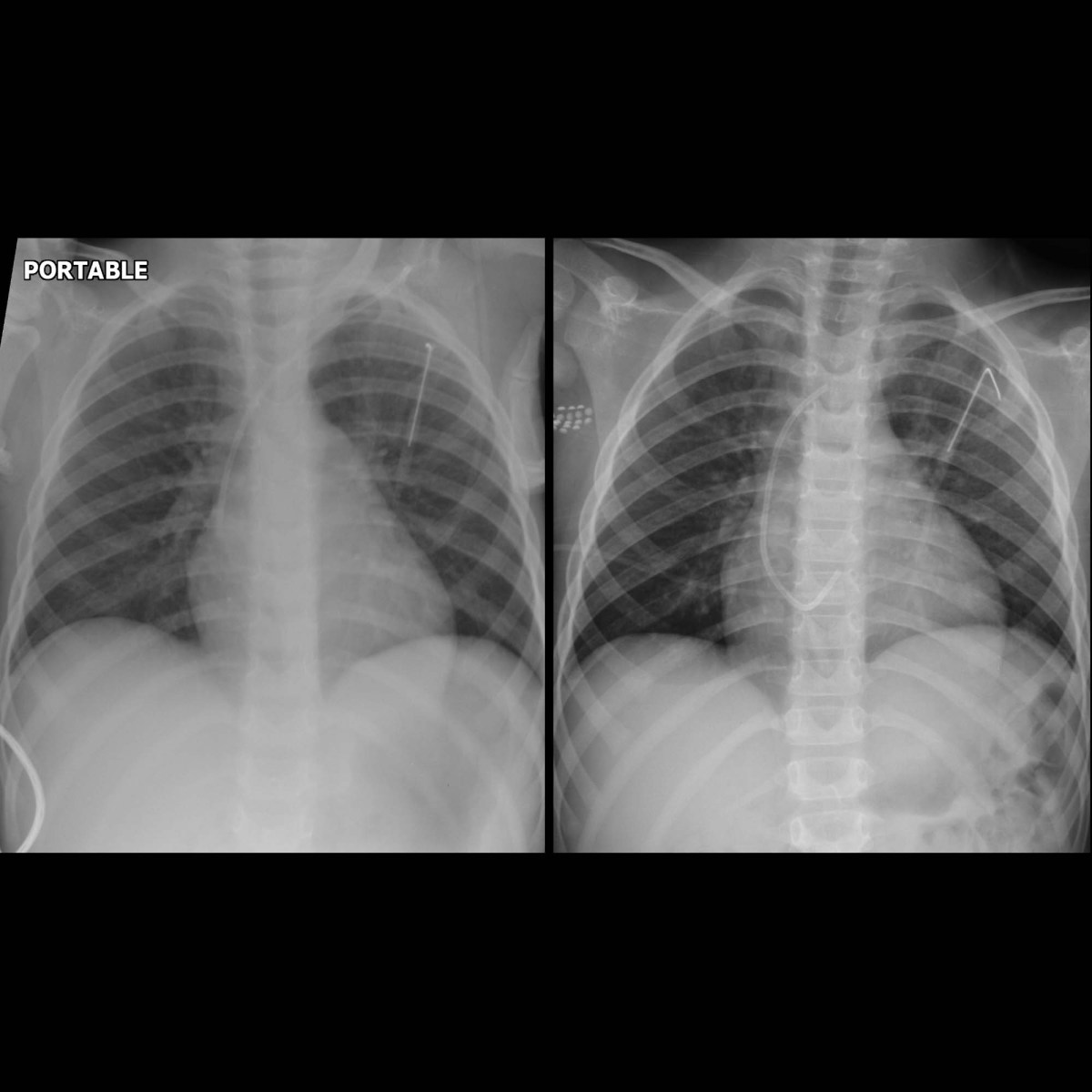 Preschooler with a central venous catheter that will no longer draw ...