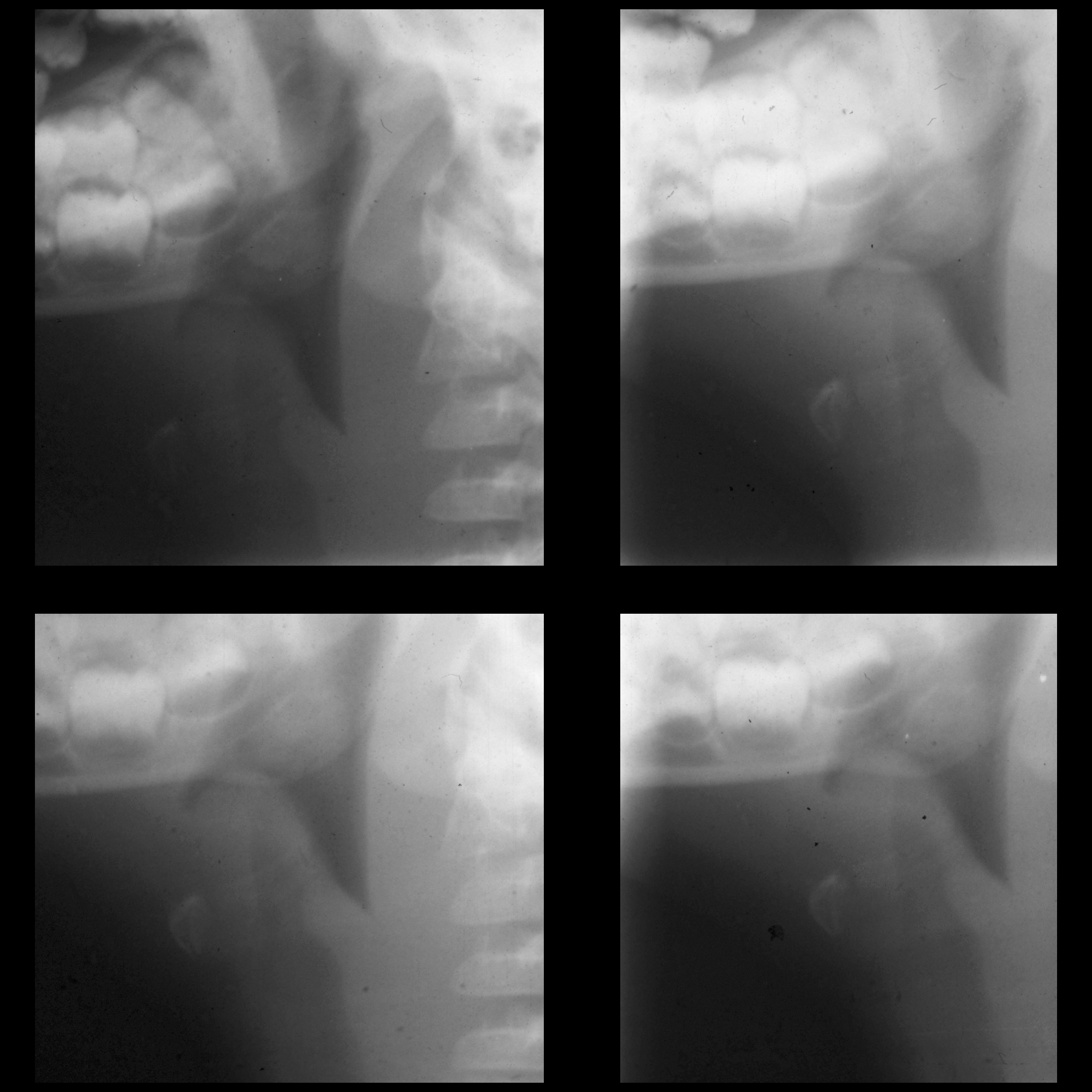 Epiglottitis | Pediatric Radiology Reference Article | Pediatric ...