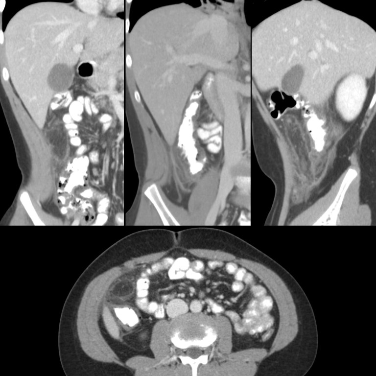 Pediatric Epiploic Appendagitis | Pediatric Radiology Reference Article ...