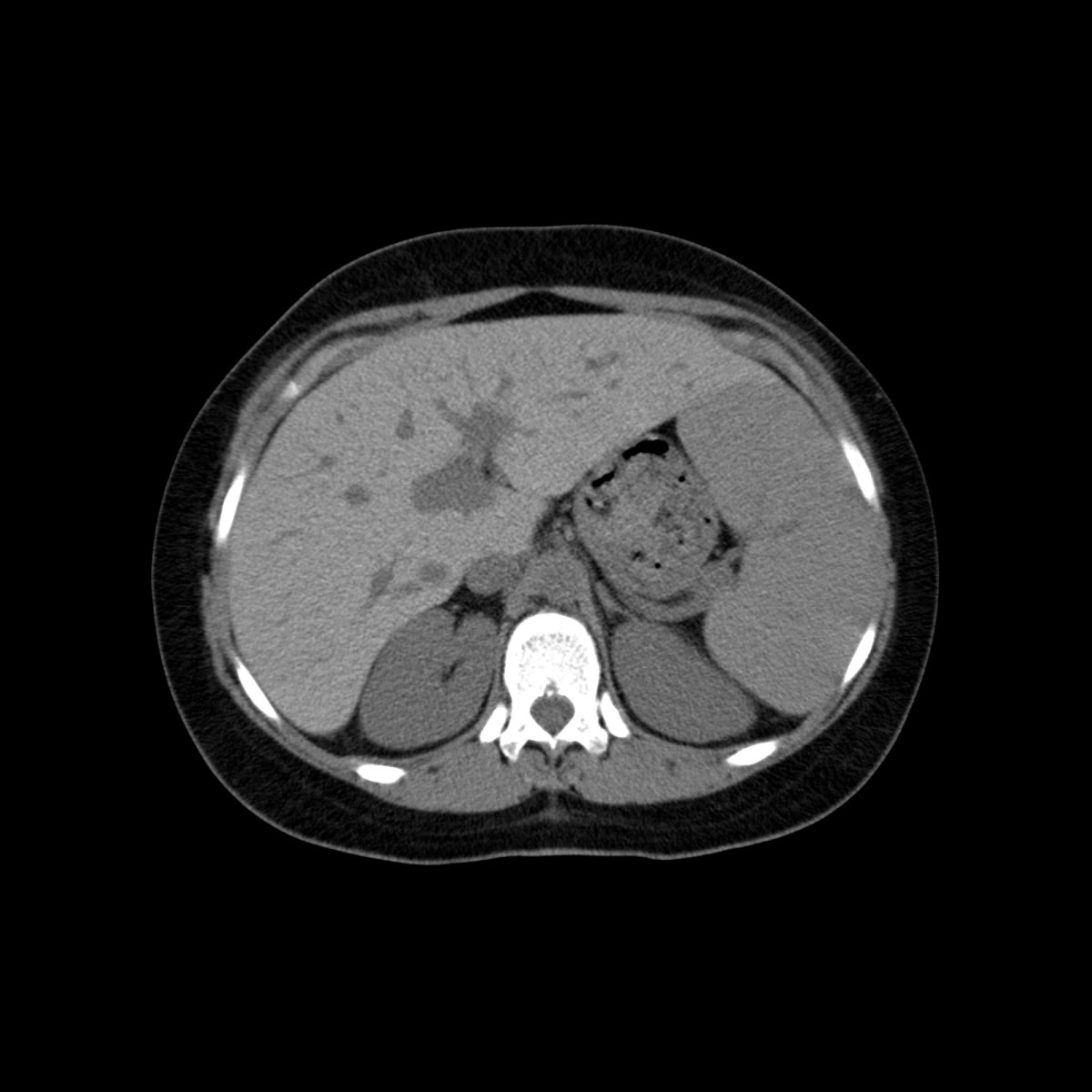 Teenager with autoimmune hemolytic anemia who has had multiple blood ...