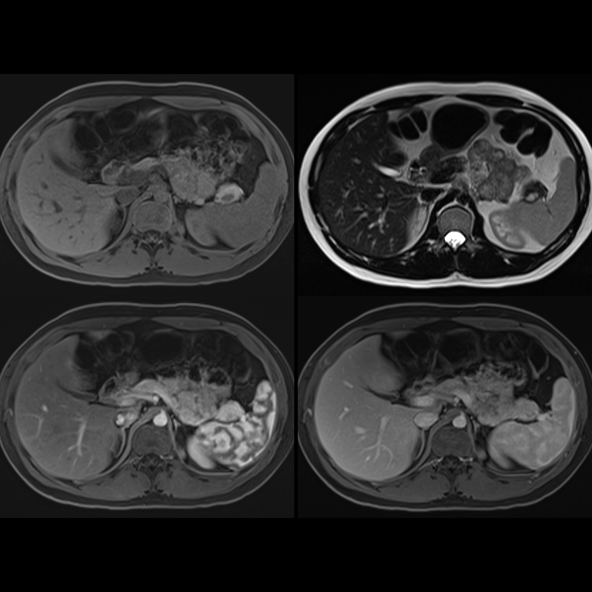 Pediatric Insulinoma | Pediatric Radiology Reference Article ...