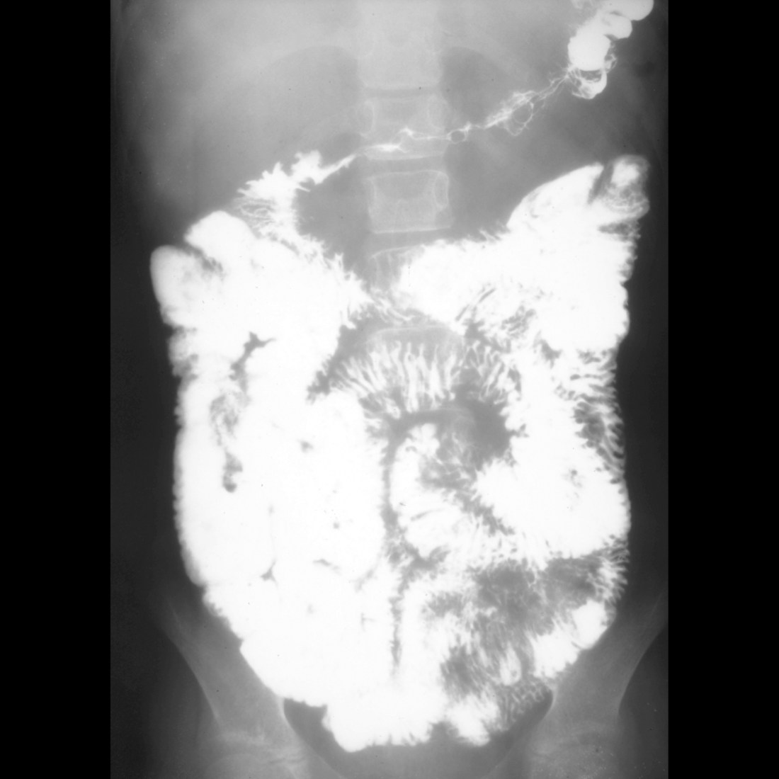 Pediatric Radiation Induced Enteritis | Pediatric Radiology Reference ...