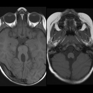 Pediatric Joubert Syndrome | Pediatric Radiology Reference Article ...