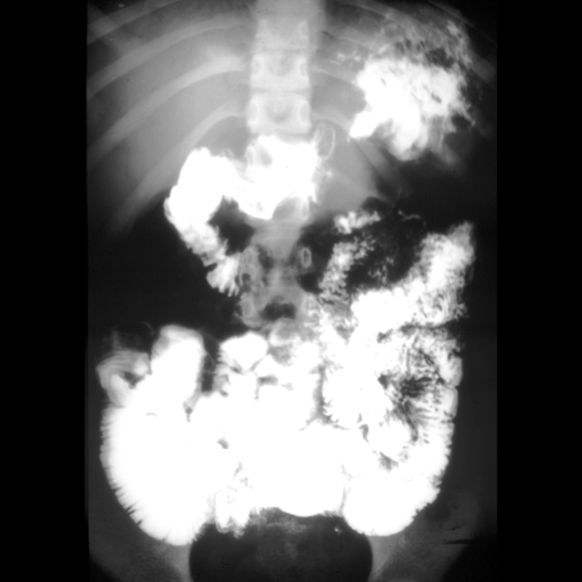 School ager with hypoproteinemia | Pediatric Radiology Case | Pediatric ...