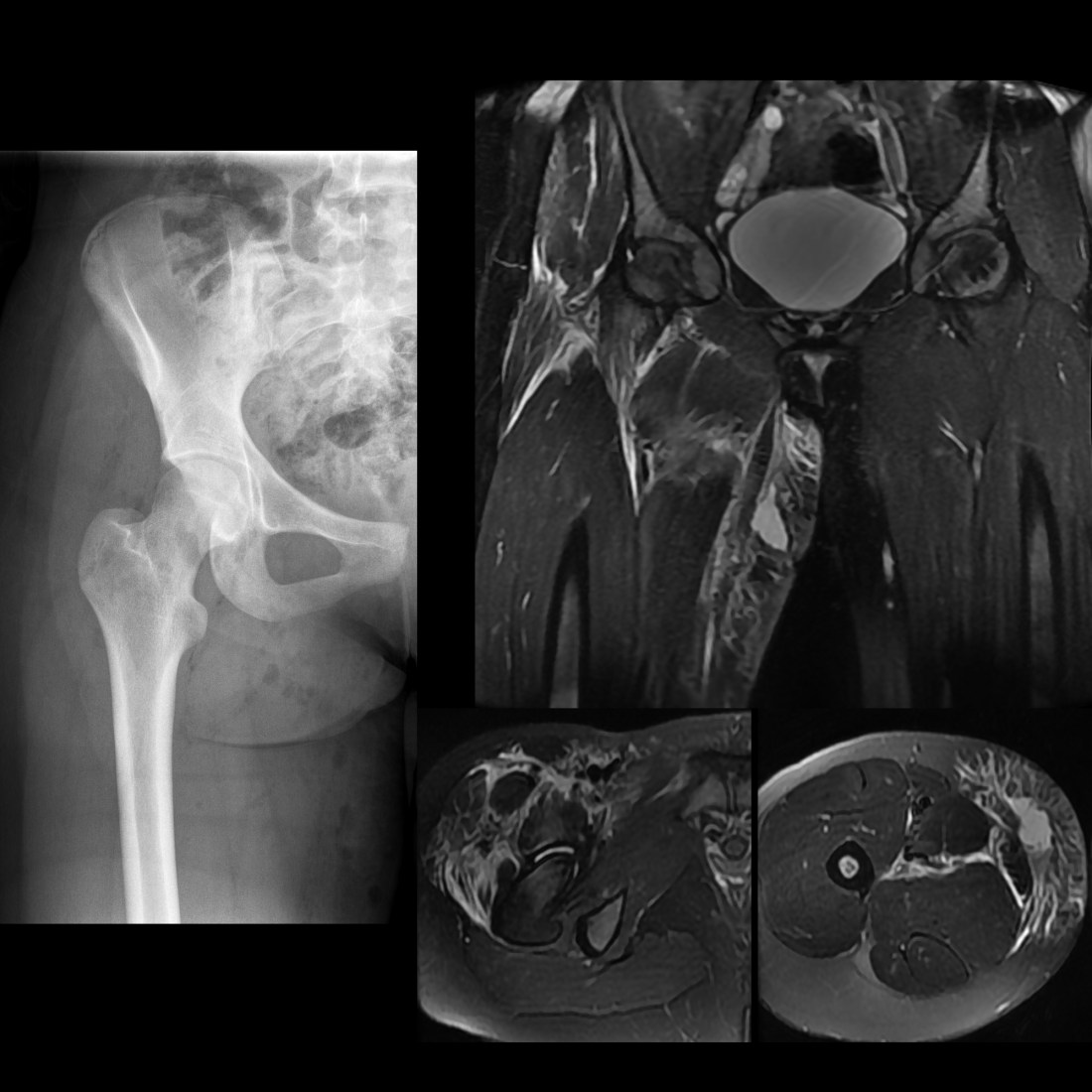 Pediatric Necrotizing Fasciitis | Pediatric Radiology Reference Article ...