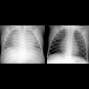 Pediatric Normal Chest | Pediatric Radiology Reference Article ...