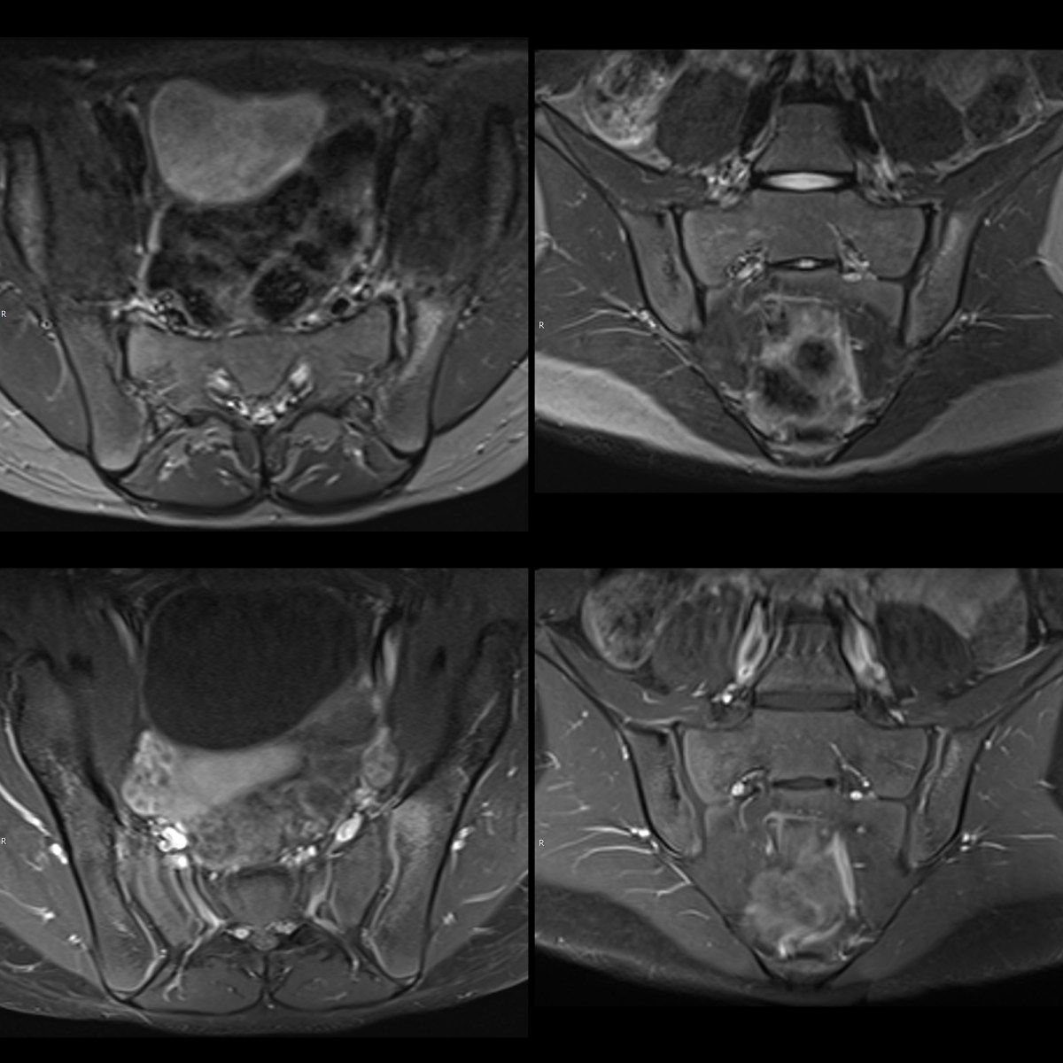 Teenager with low back pain | Pediatric Radiology Case | Pediatric ...