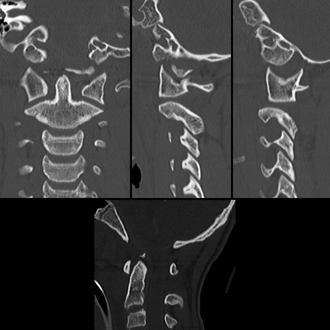 Pediatric Atlanto-Occipital Dissociation | Pediatric Radiology ...