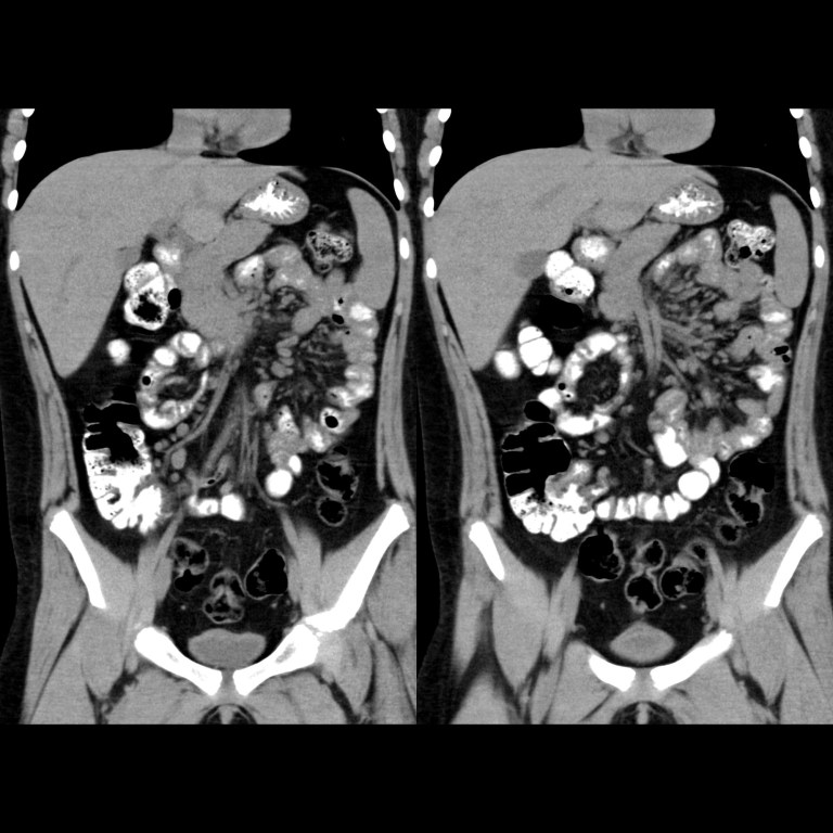 Pediatric Mesenteric Adenitis | Pediatric Radiology Reference Article ...