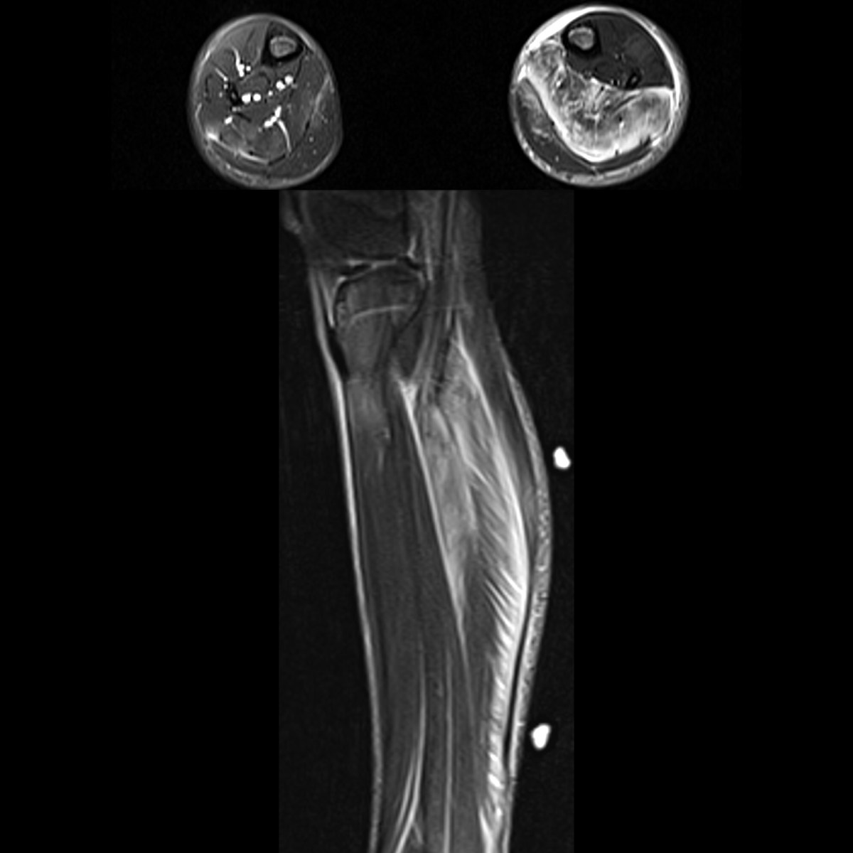 School ager with left calf pain and eosinophillia | Pediatric Radiology ...