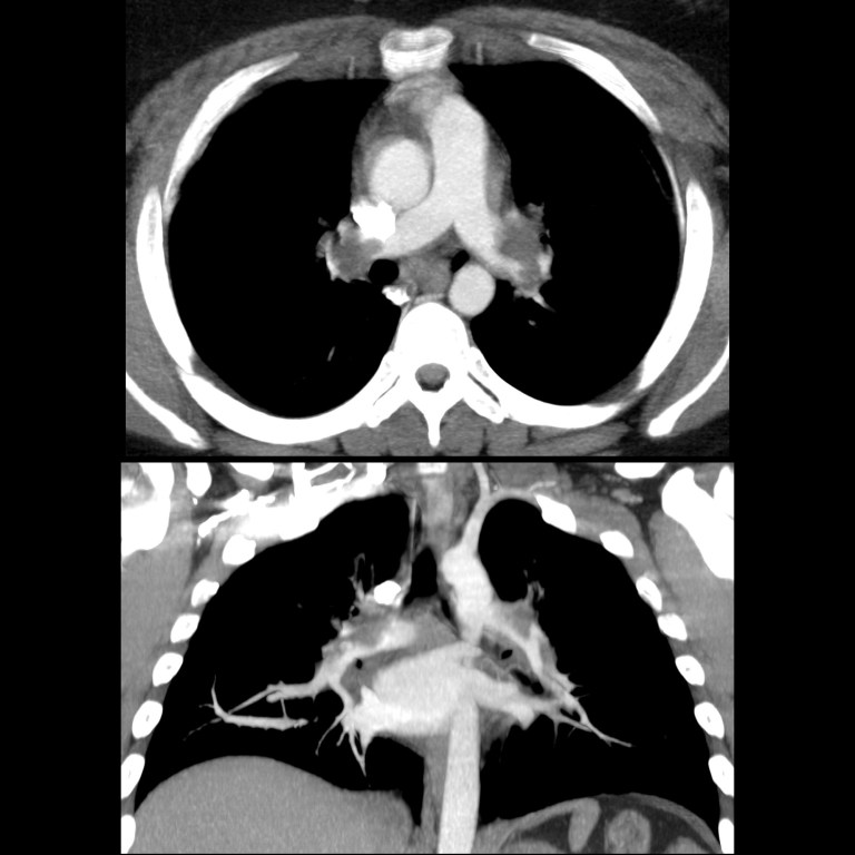 Pediatric Pulmonary Embolism | Pediatric Radiology Reference Article ...