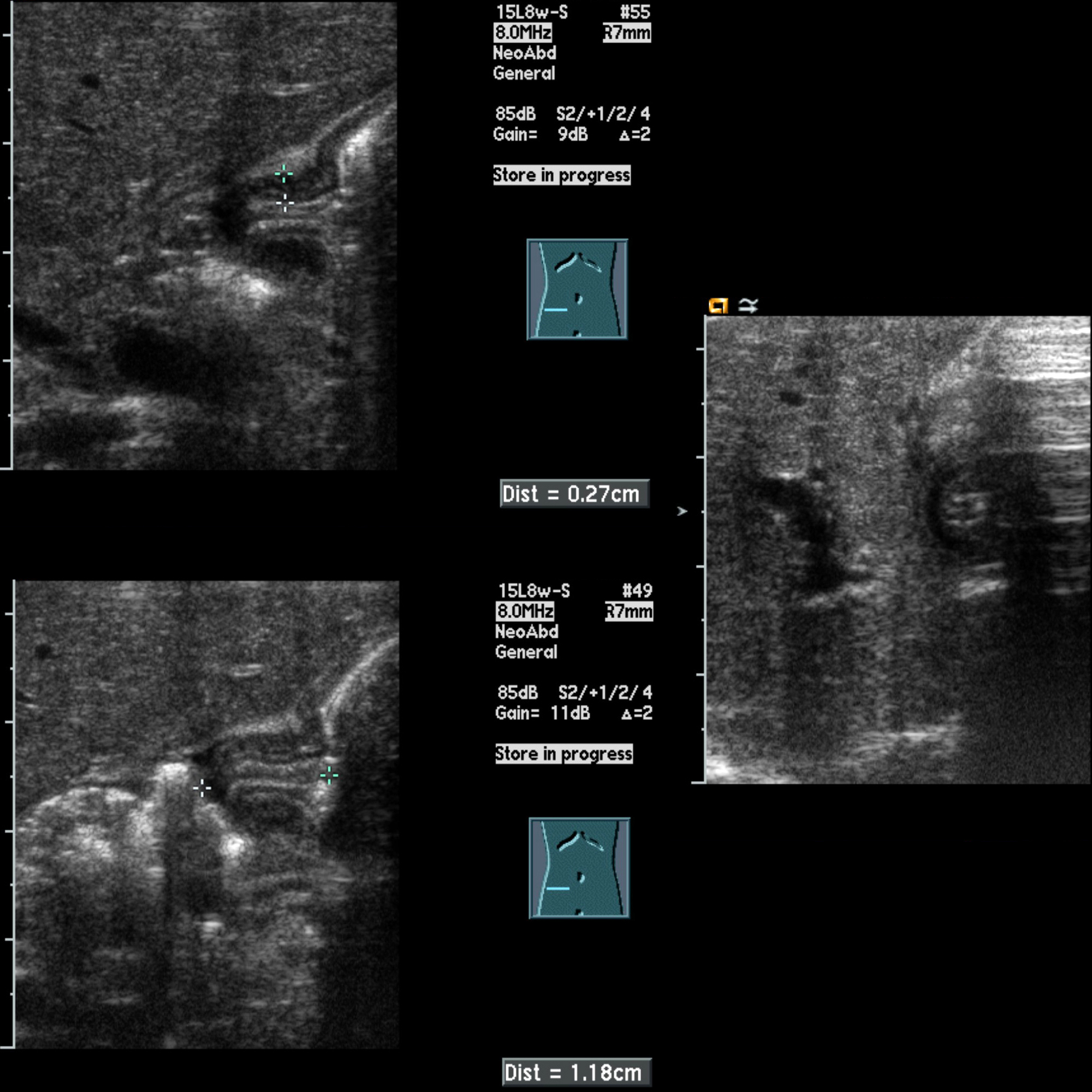 Hypertrophic Pyloric Stenosis | Pediatric Radiology Reference Article ...
