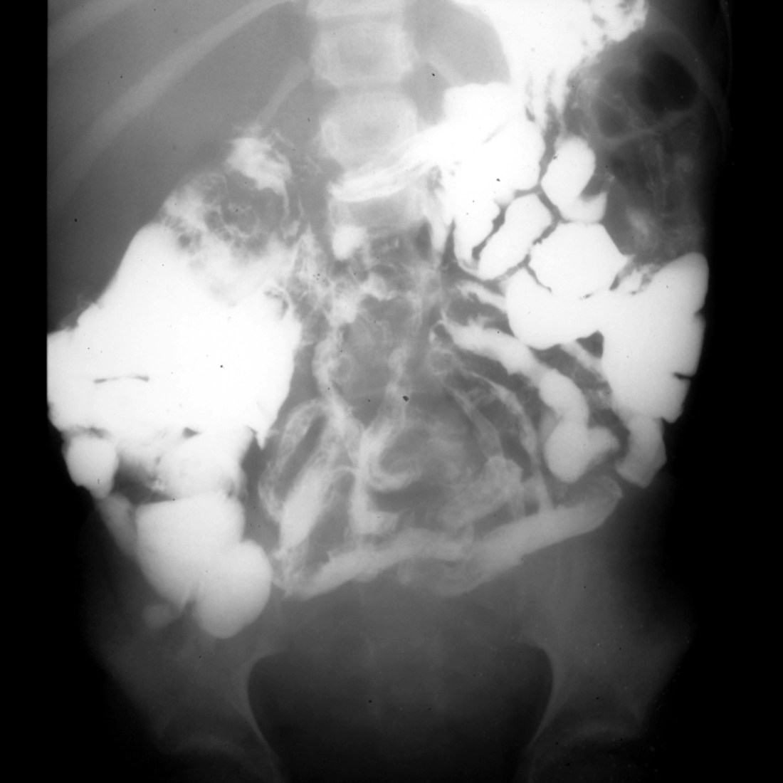 Pediatric Radiation Induced Enteritis | Pediatric Radiology Reference ...