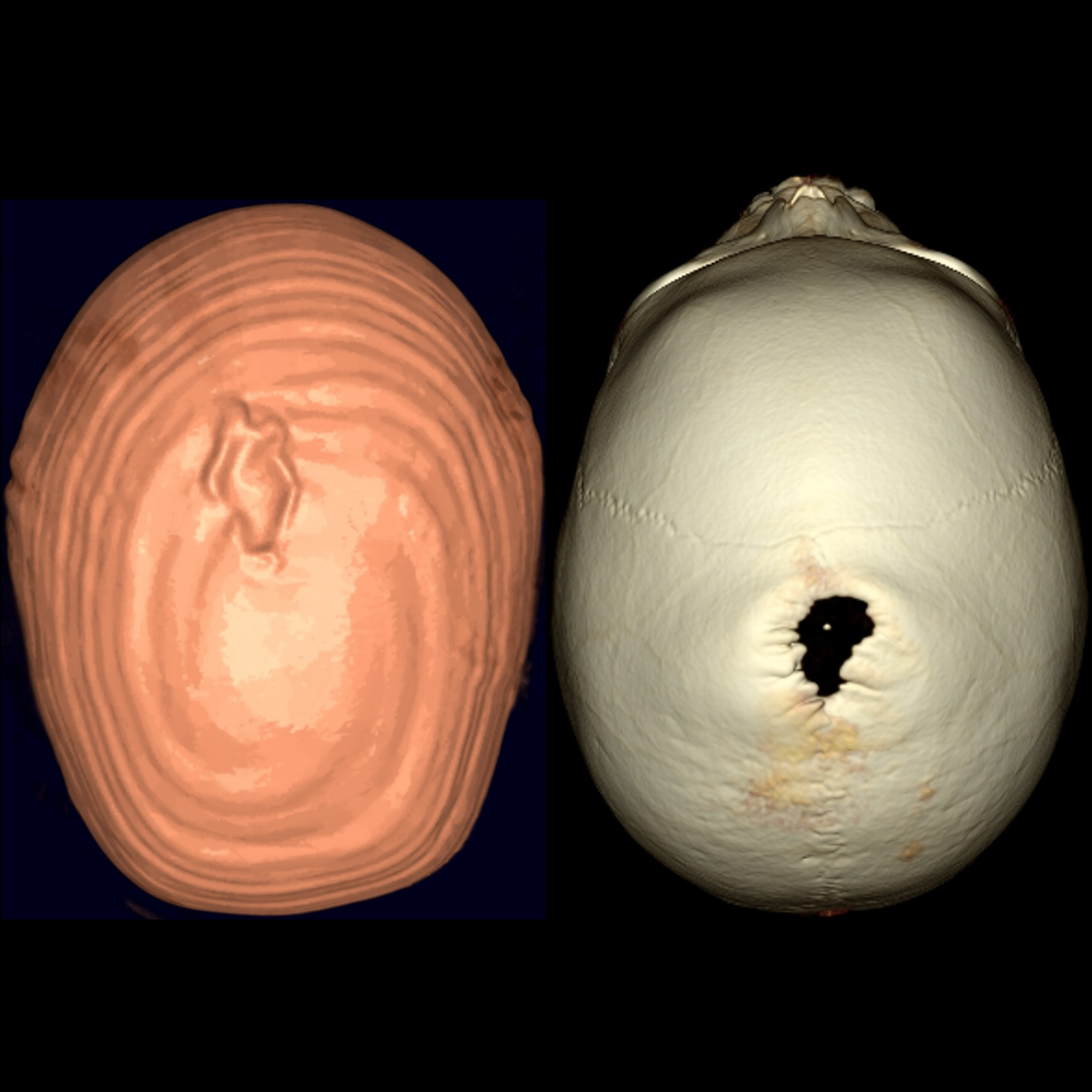 AplasiaCutis01MDScalpDefectAtBirthSkullDefectAnteriorAspectSagittalSutu ...