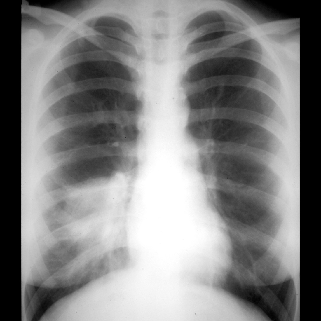 Chest X Ray Asthma Asthma | Pathology Tests Explained