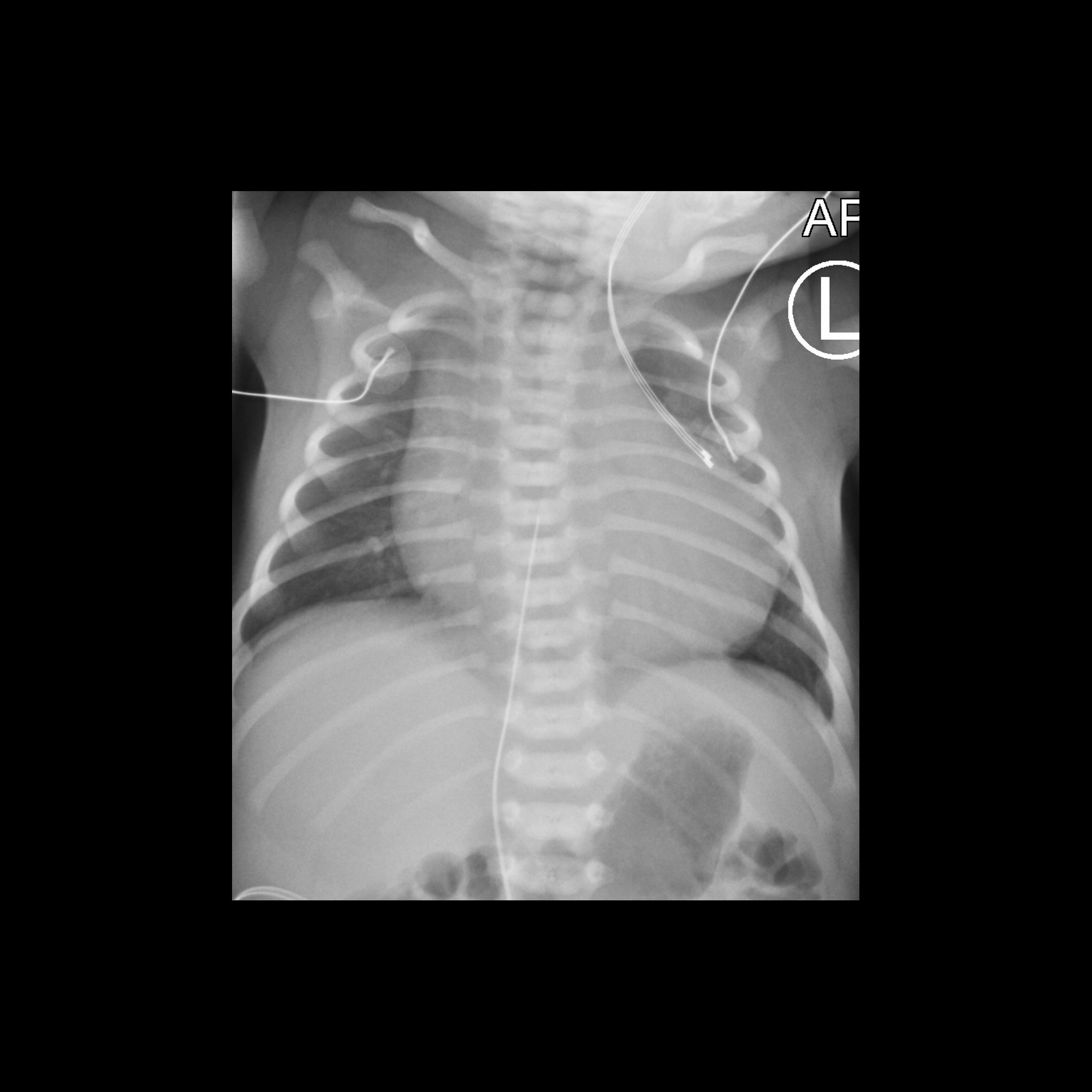 Cardiomyopathy | Pediatric Radiology Reference Article | Pediatric ...