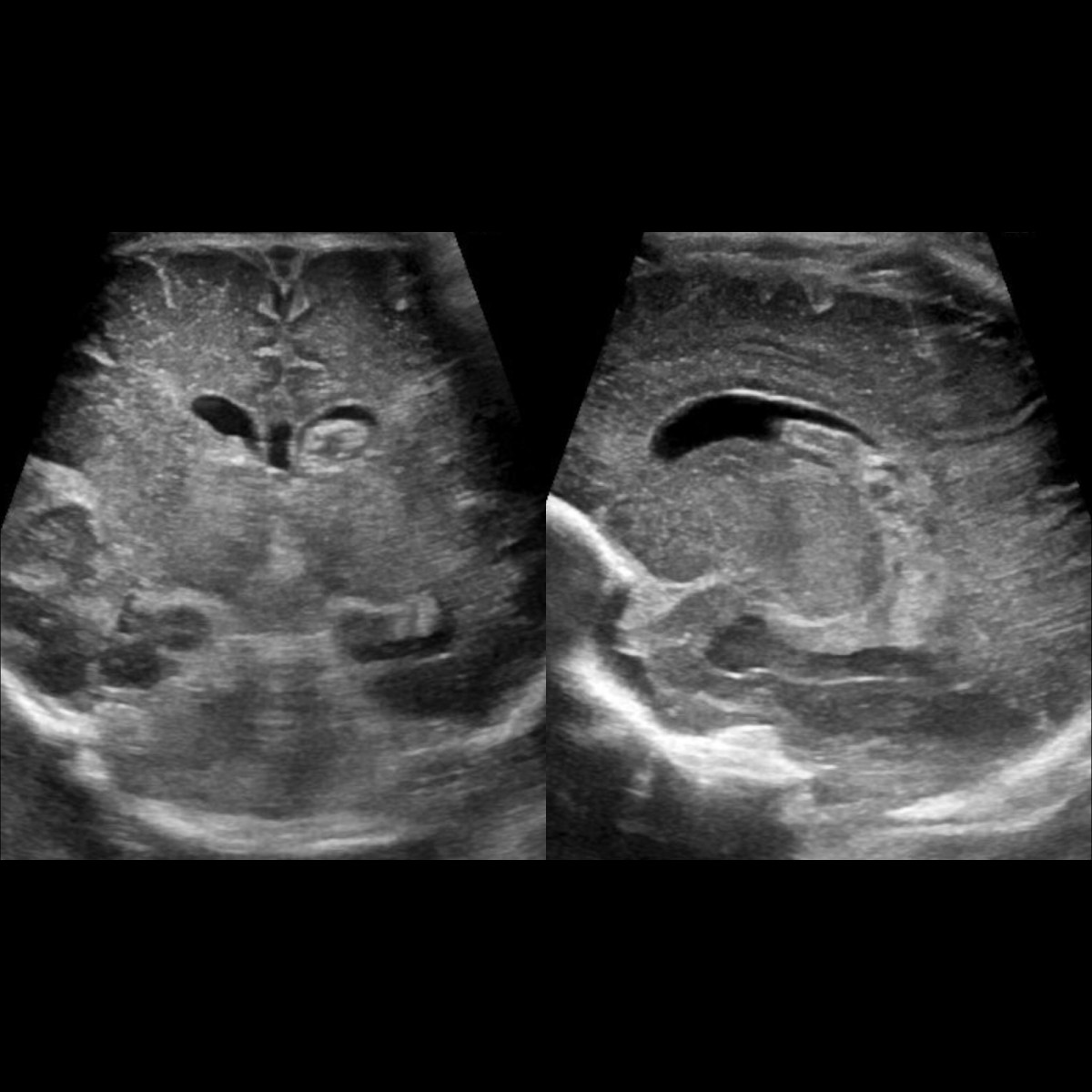 Premature newborn with metabolic acidosis | Pediatric Radiology Case ...