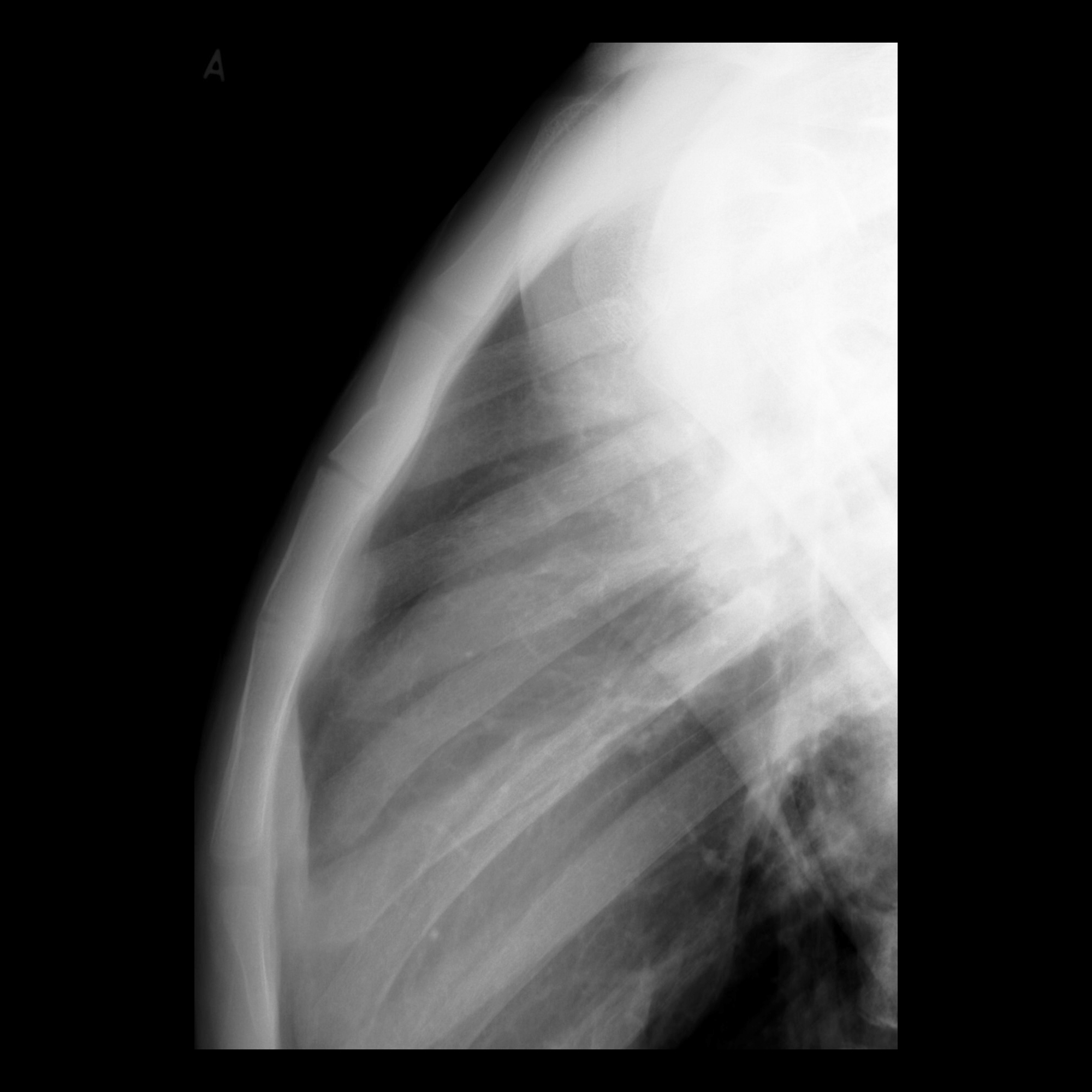 Pediatric Sternum Fracture | Pediatric Radiology Reference Article ...