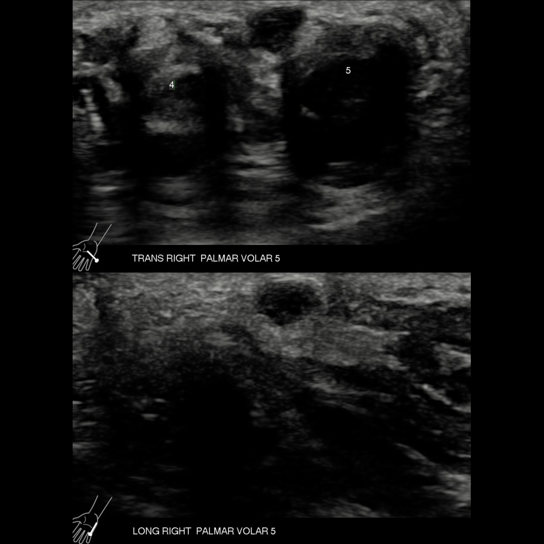 Pediatric Ganglion Cyst / Synovial Cyst | Pediatric Radiology Reference ...