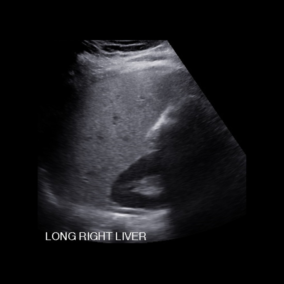 Pediatric Hepatic Steatosis | Pediatric Radiology Reference Article ...