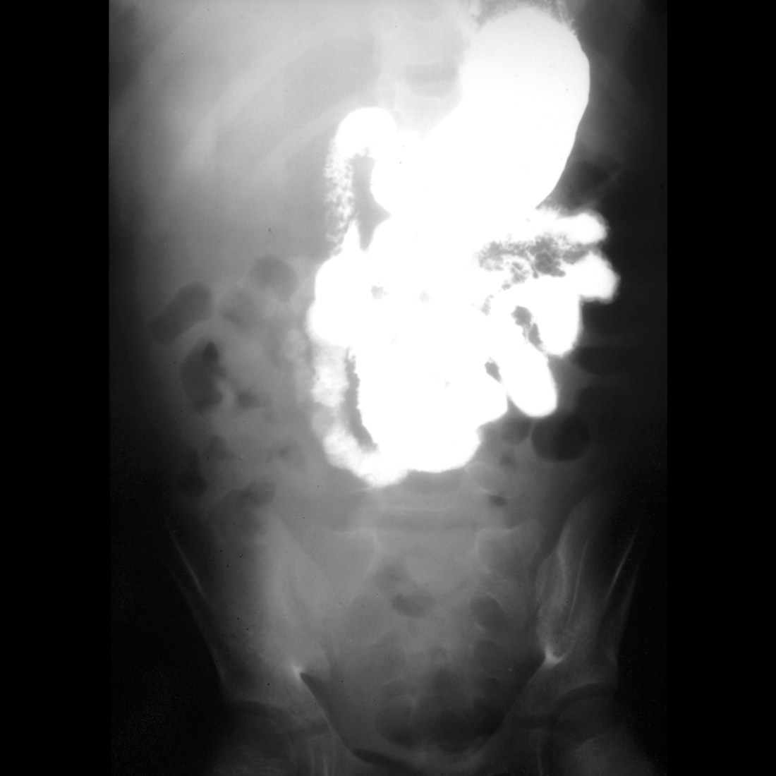 Pediatric Hypoalbuminemia | Pediatric Radiology Reference Article ...