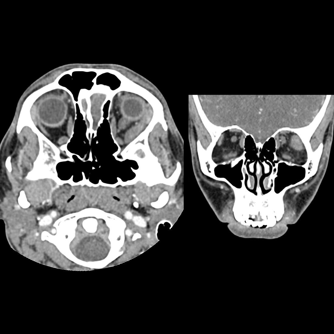 Pediatric Idiopathic Orbital Inflammation | Pediatric Radiology ...
