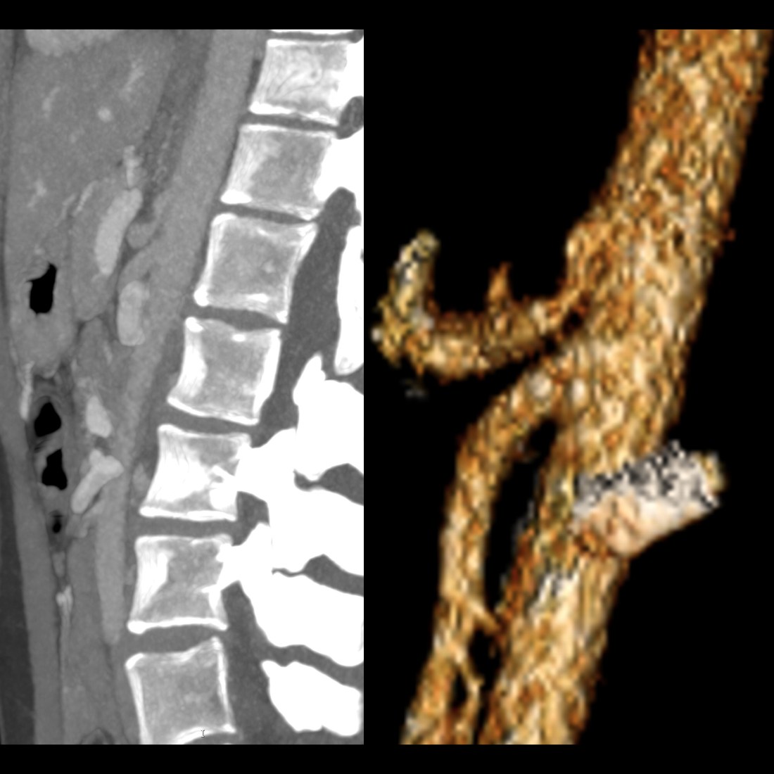 Pediatric Median Arcuate Ligament Syndrome | Pediatric Radiology ...