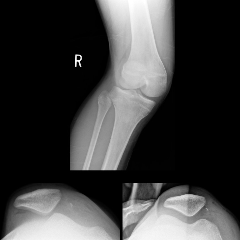 Pediatric Patellar Dislocation | Pediatric Radiology Reference Article ...