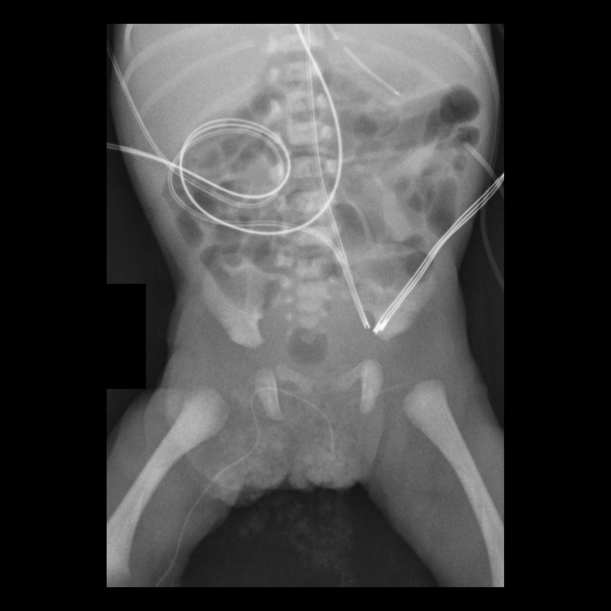 Premature newborn after PICC line placement | Pediatric Radiology Case ...