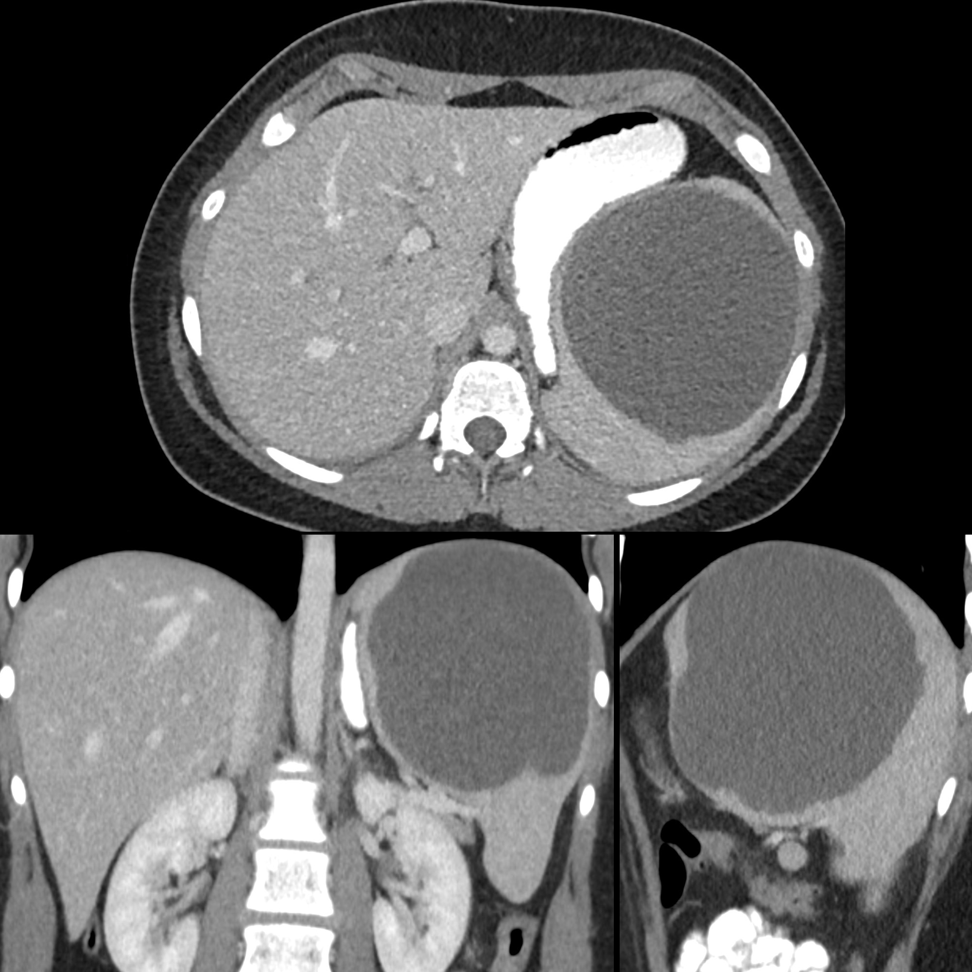 Pediatric Splenic Cyst | Pediatric Radiology Reference Article ...