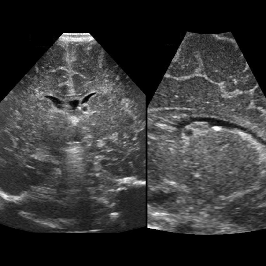 Pediatric Subependymal Cyst | Pediatric Radiology Reference Article ...