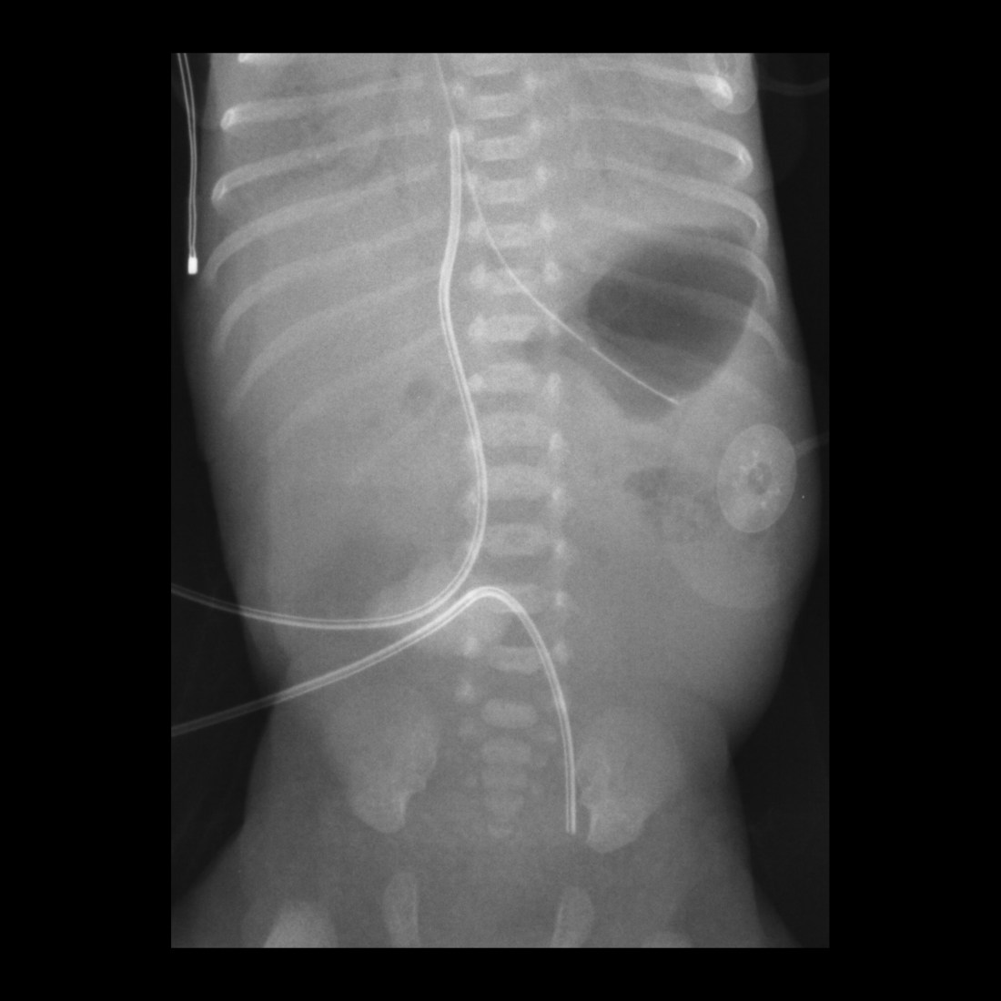 Premature newborn after umbilical arterial catheter placement ...