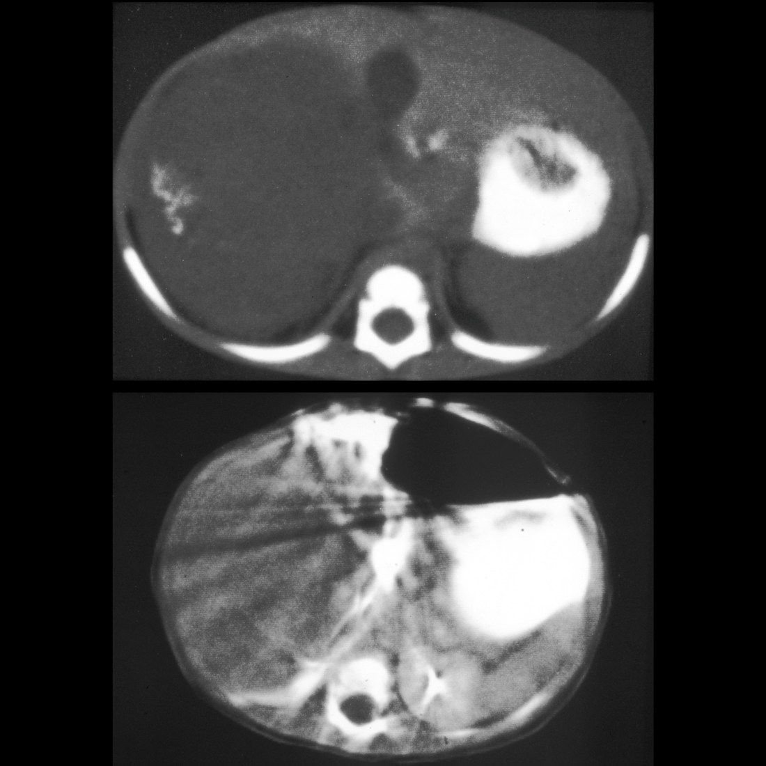Infant with an abdominal mass | Pediatric Radiology Case | Pediatric ...