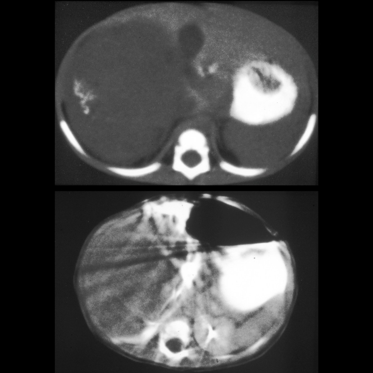 Infant with an abdominal mass | Pediatric Radiology Case | Pediatric ...