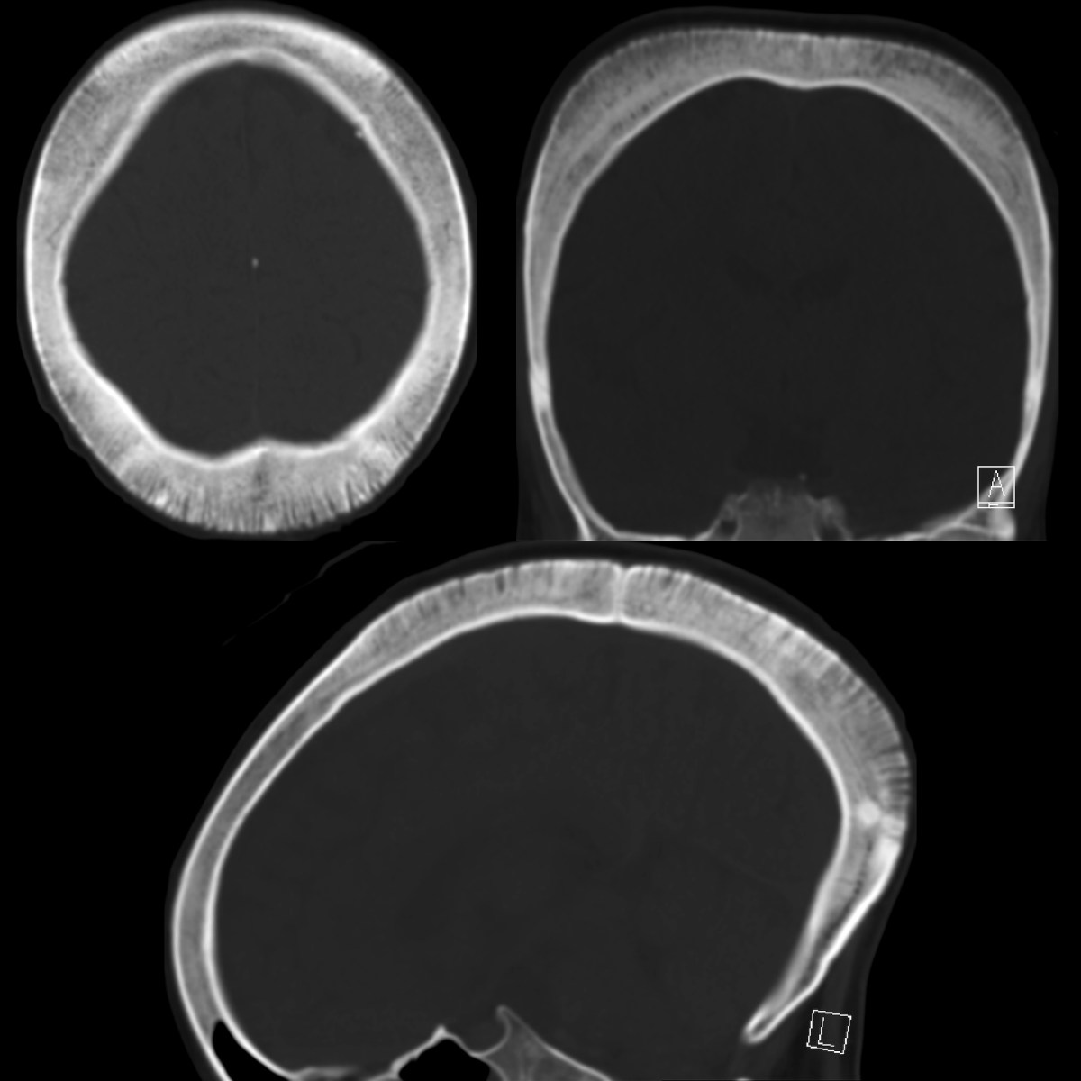 Young adult with sickle cell disease and a headache | Pediatric ...