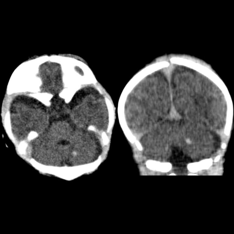 Pediatric Subgaleal Hematoma | Pediatric Radiology Reference Article ...