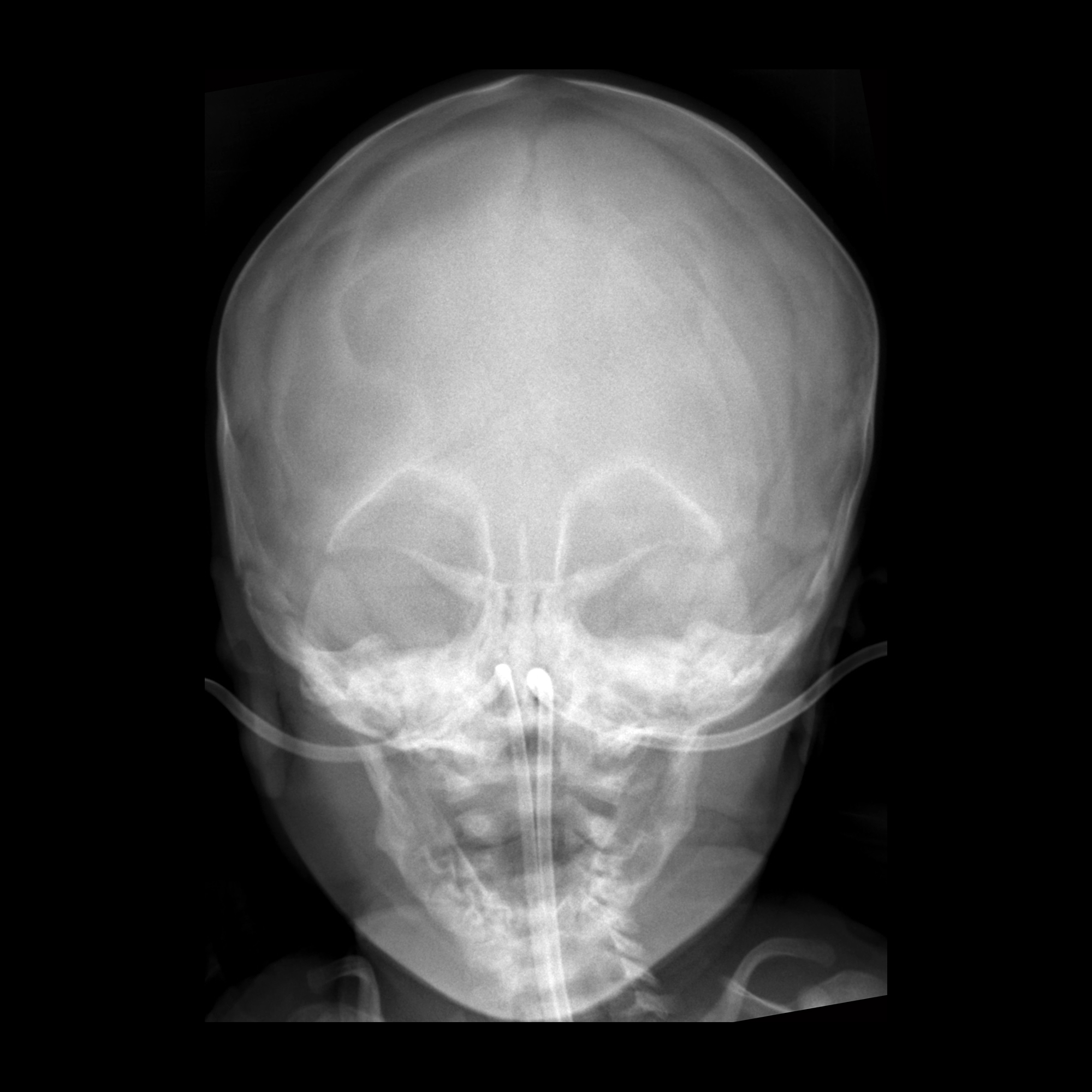 Craniosynostosis | Pediatric Radiology Reference Article | Pediatric ...