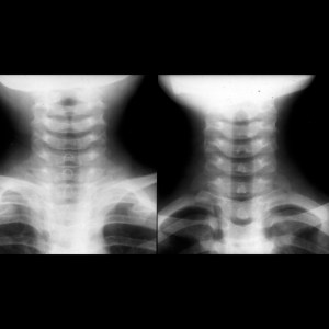 Croup | Pediatric Radiology Reference Article | Pediatric Imaging ...