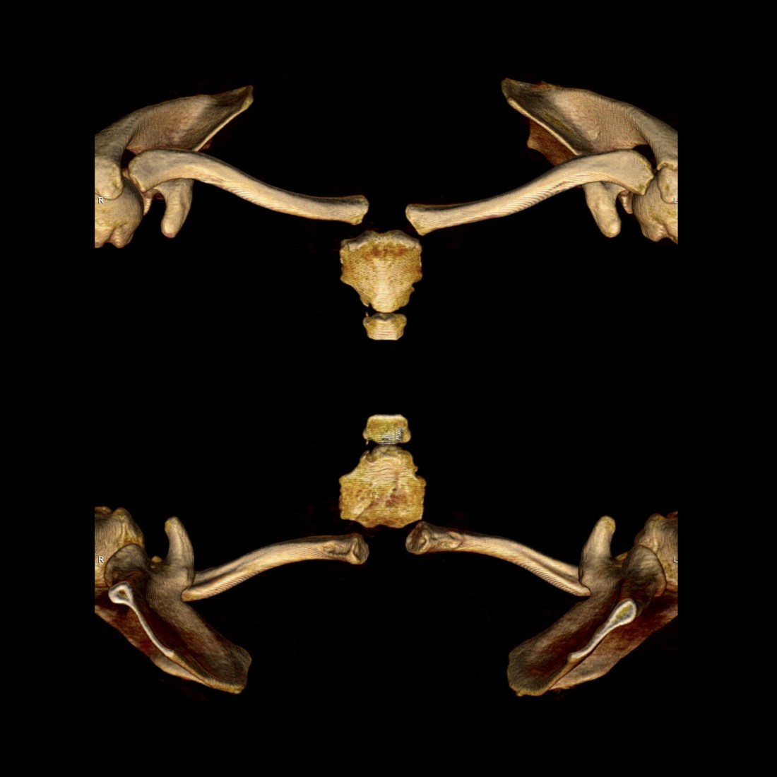 Pediatric Sternoclavicular Joint Dislocation | Pediatric Radiology ...