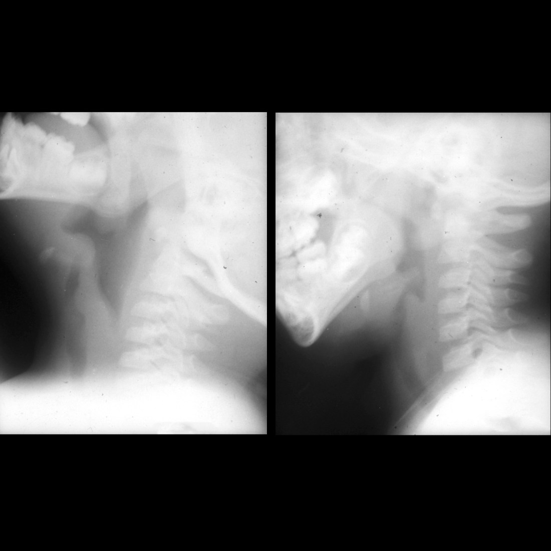 Epiglottitis | Pediatric Radiology Reference Article | Pediatric ...