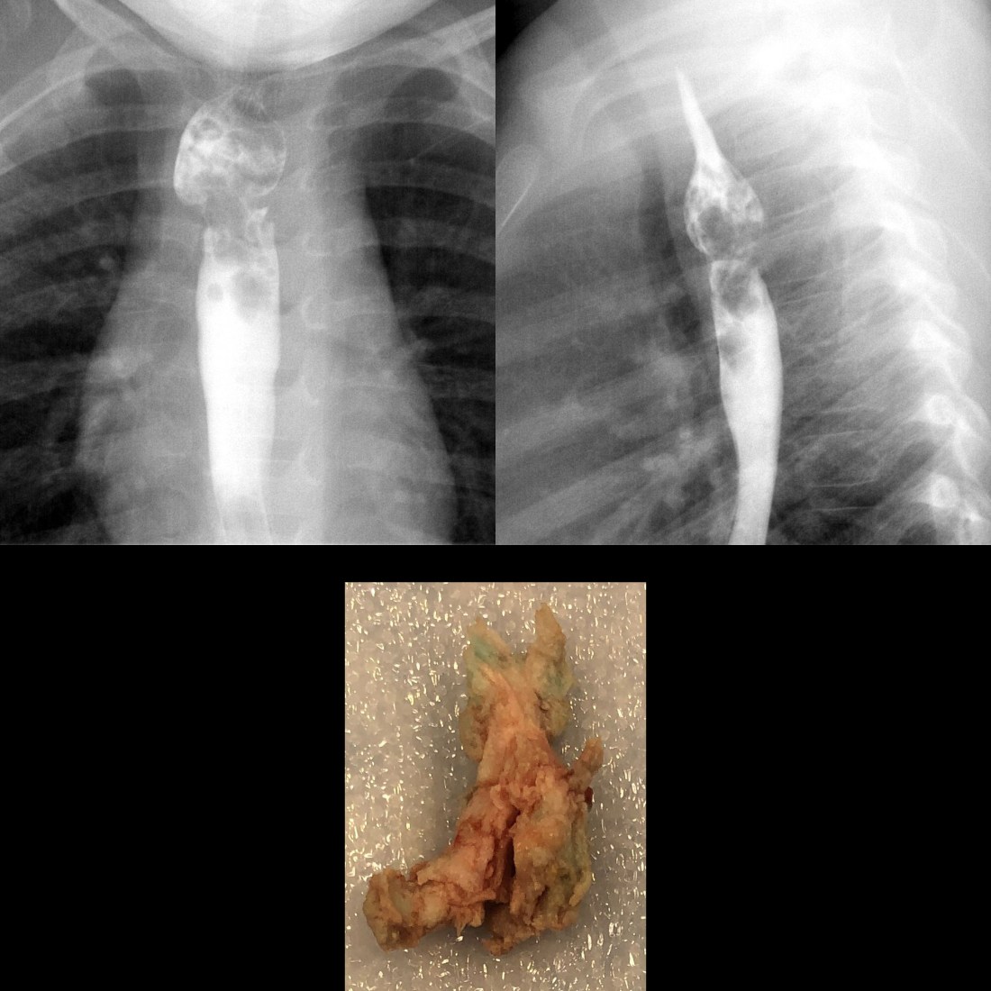 Esophageal Atresia | Pediatric Radiology Reference Article | Pediatric ...