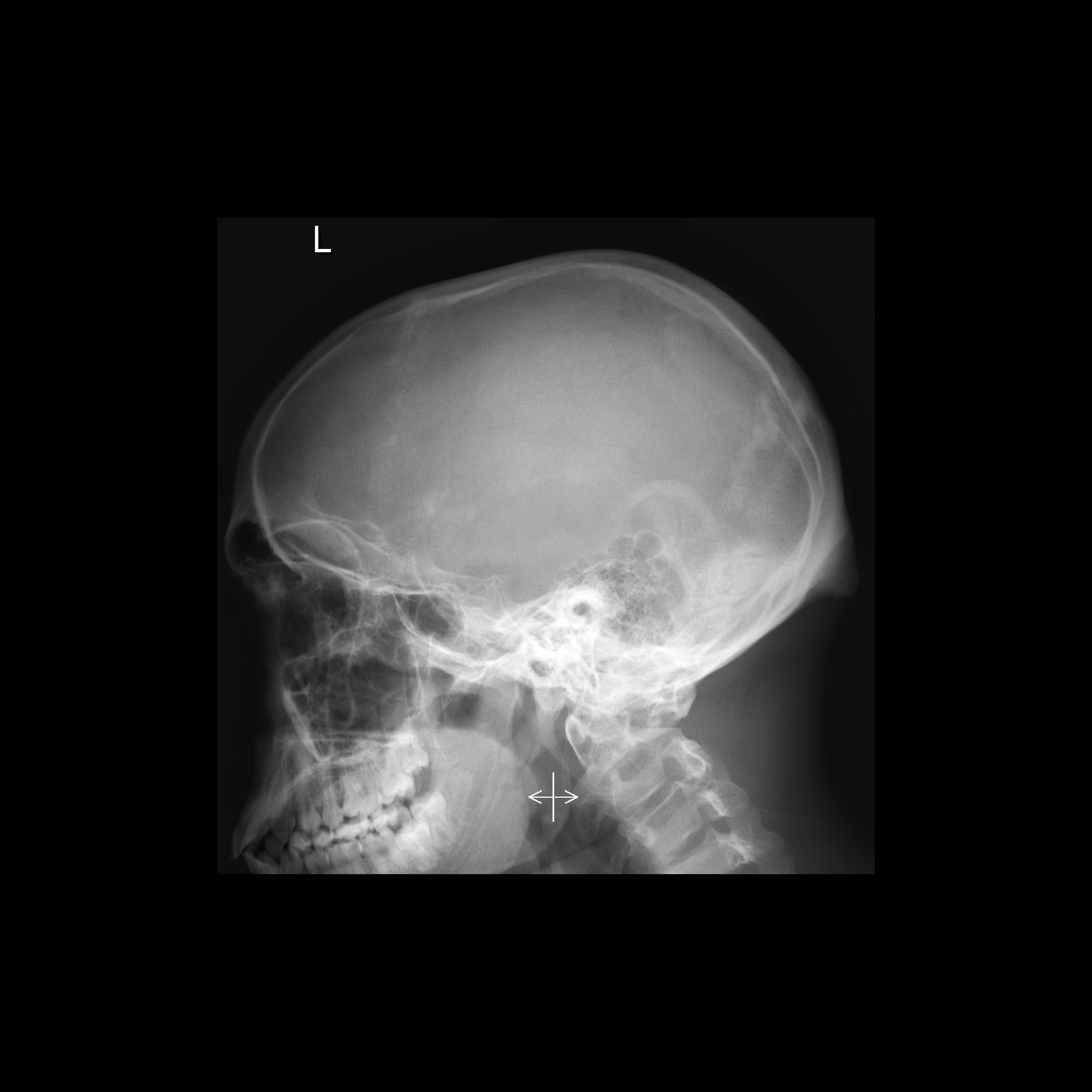 Pediatric External Occipital Protuberance | Pediatric Radiology ...
