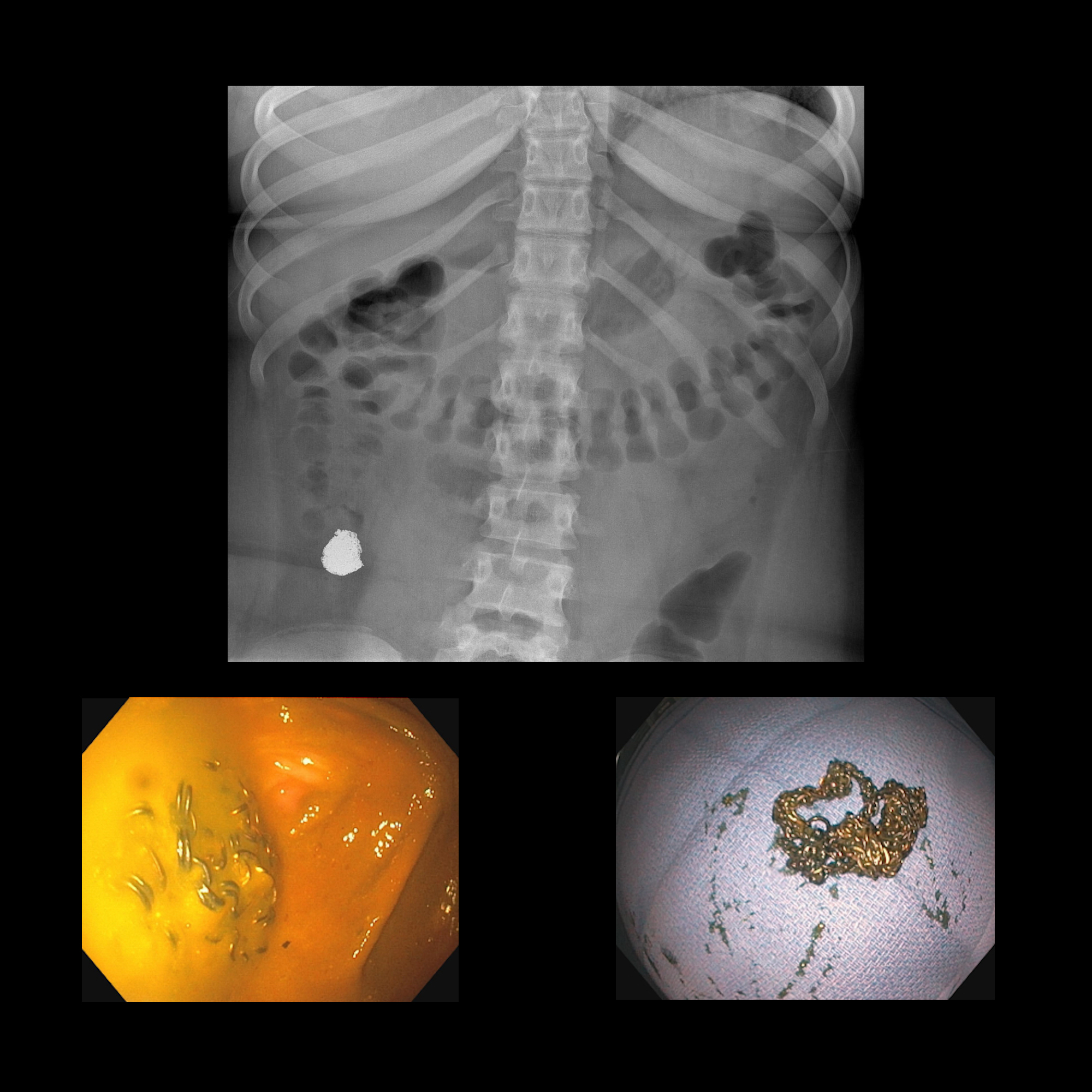 ForeignBody05MDColonChainsAXR14yo | Pediatric Radiology Case ...