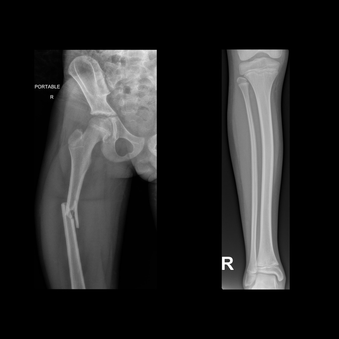 Pediatric Bowing Fracture | Pediatric Radiology Reference Article ...