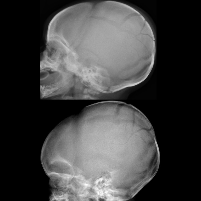 Pediatric Skull Fracture | Pediatric Radiology Reference Article ...
