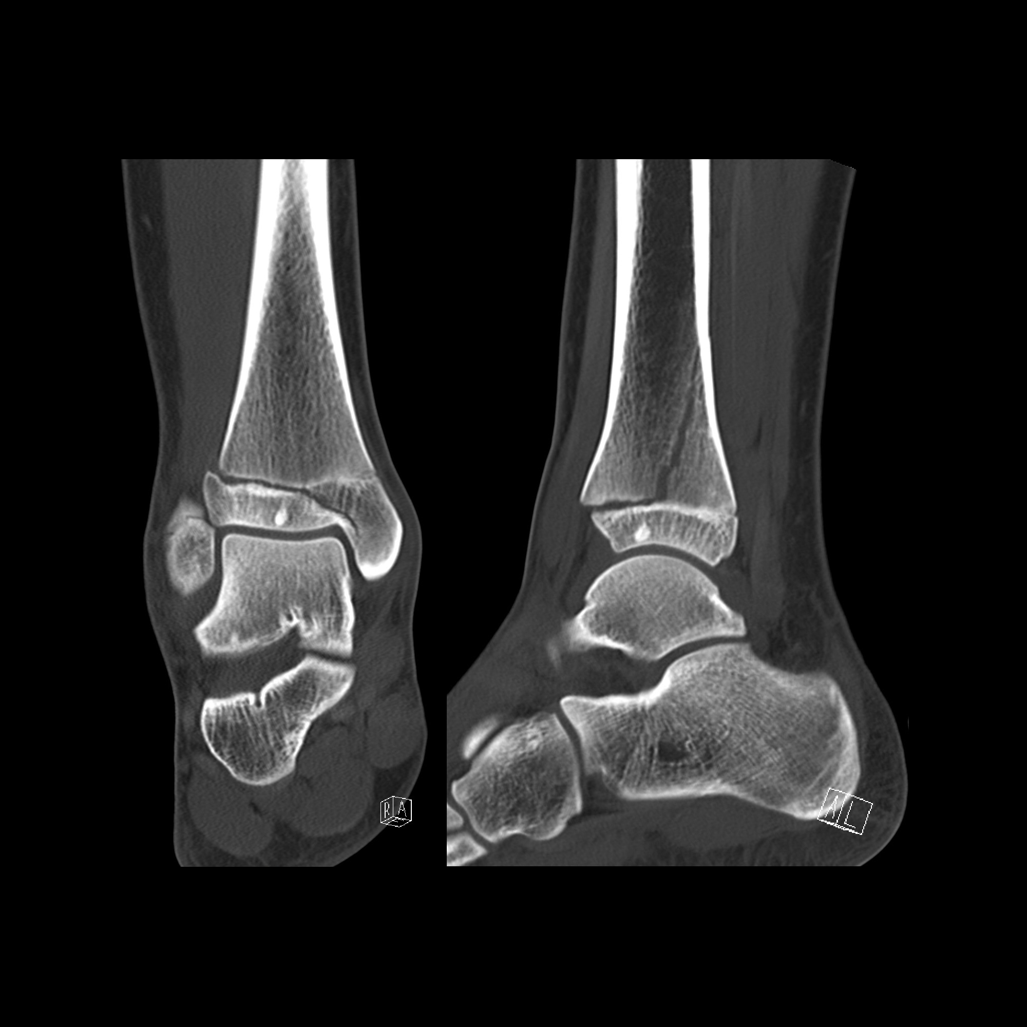 Salter-Harris Fracture | Pediatric Radiology Reference Article ...