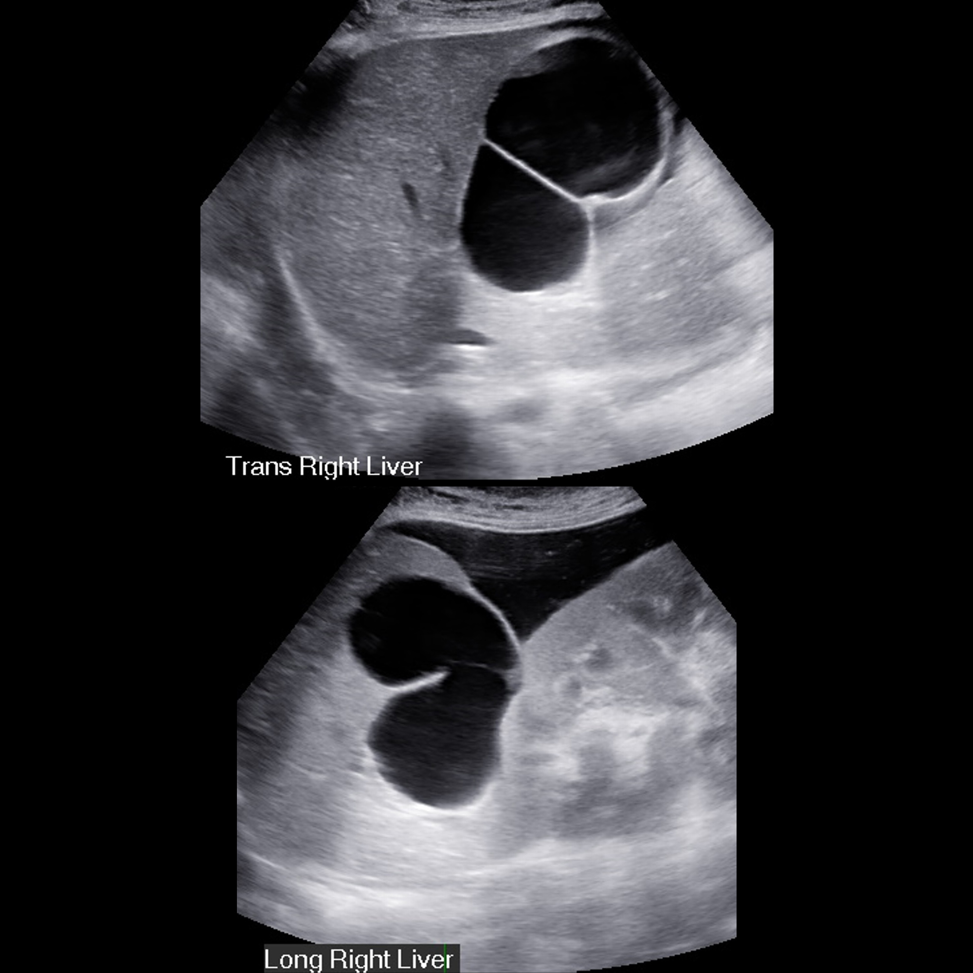 Pediatric Gallbladder Hydrops | Pediatric Radiology Reference Article ...