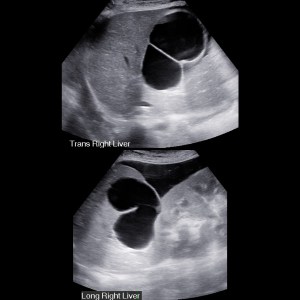 Pediatric Gallbladder Hydrops | Pediatric Radiology Reference Article ...